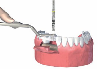 Straumann releases Guided Surgery Kit – OSSEOTECH