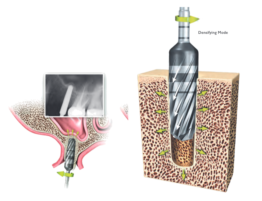versah – OSSEOTECH